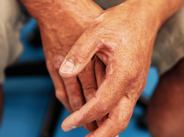 RBWH Foundation : Project: Development of a person-centred outcome ...